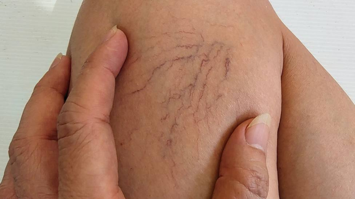 Toda la verdad sobre la aparición de varices en las mujeres durante un ...