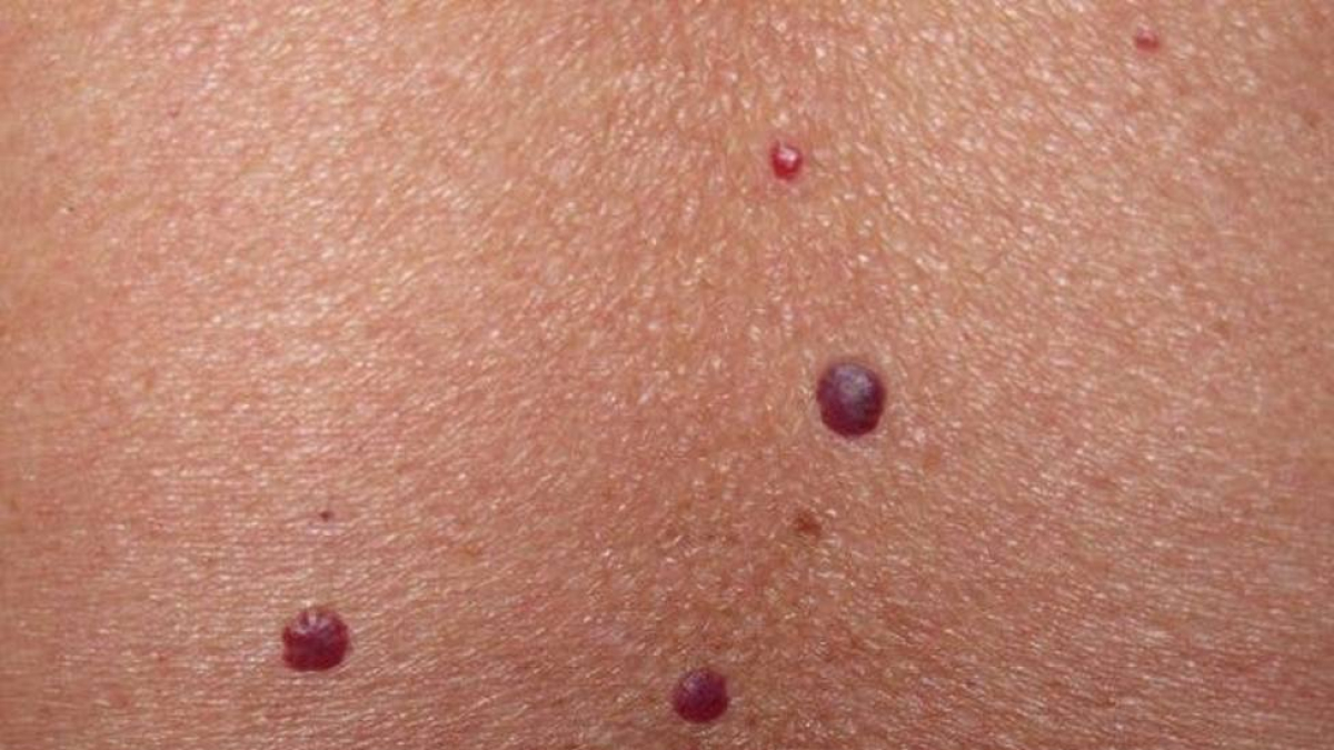 Descubre si son peligrosos los puntos rojos que aparecen en la piel